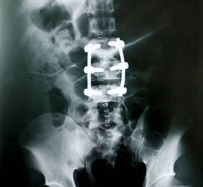 Know FBSS - answer the Quiz - Pain Treatment and Management Articles ...