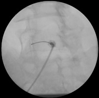 Facet Joint Pain Syndrome, Treatment Clinic For Facet Joint Pain Syndrome